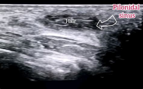 Pilonidal Cyst Mri