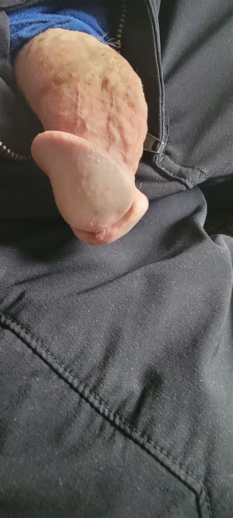 My Split Glans Pics Xhamster