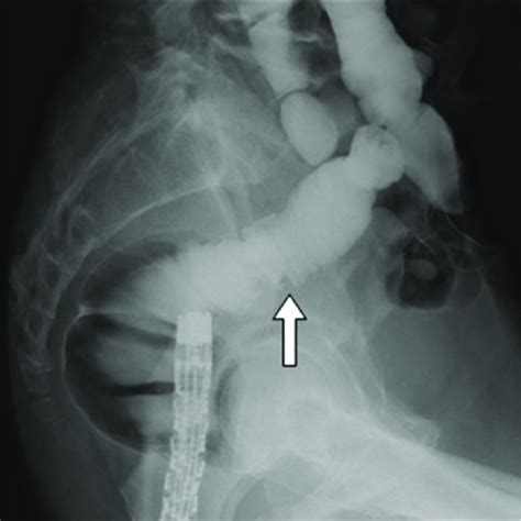 Extracted Opened Specimens There Was A Fecalith In The Tip Of The Download Scientific Diagram