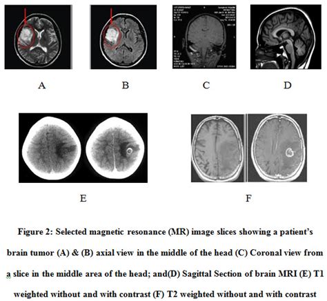 A Hybrid Method For Brain Tumor Detection Using Advanced Textural