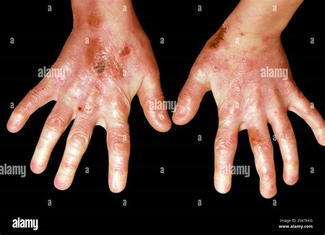 Epidermolysis Bullosa Eb Blisters On The Hands Of A 30 Year Old Woman