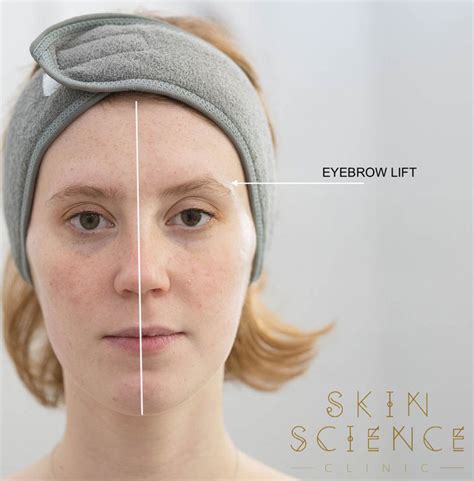 Hooded Eyelids Skin Science Clinic