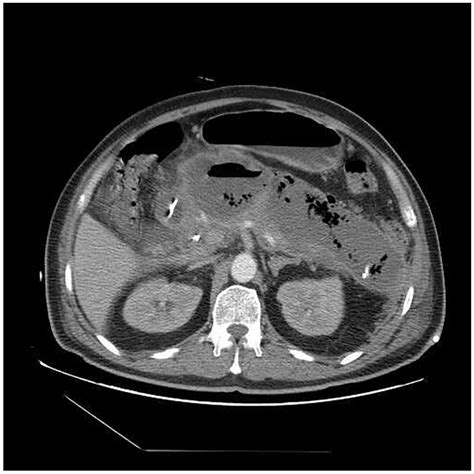 Computed Tomography Of The Abdomen Before Necrosectomy Axial View Download Scientific