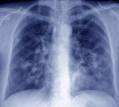 Diffuse Interstitial Pneumonia Lung X Ray Stock Image C0384544 Science Photo Library Diffuse Interstitial Pneumonia Lung X Ray Stock Image C0384544 Science Photo Library