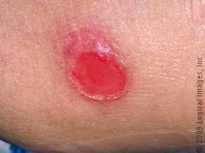 Early Detection Pressure Ulcers