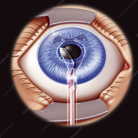 Intraocular Lens Stock Image C0027252 Science Photo Library Intraocular Lens Stock Image C0027252 Science Photo Library