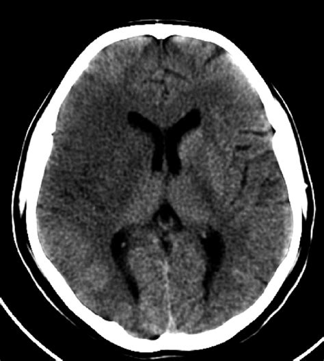 Non Contrast Computerised Tomography Ct Of Head Showed Sulcal Download Scientific Diagram