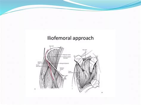 Approach To Acetabulum Fracture Zoom 2020 Ppt