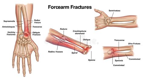 An Anatomical Illustration Of Forearm Fractures Highlighting Various