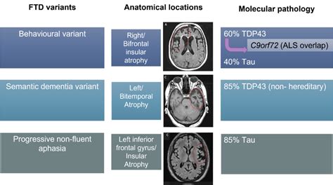 Frontotemporal Dementia Ftd Mind The Bleep