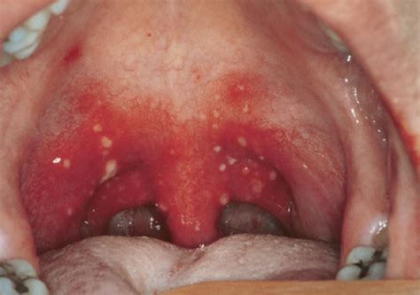 Герпес в горле у ребенка как лечить вирусную инфекцию