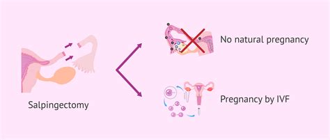 Salpingectomy How And Why Are The Fallopian Tubes Extracted