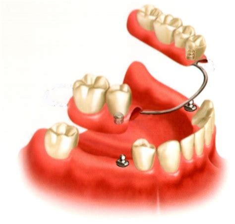 Implant Supported Partial Dentures
