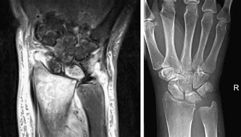 Case 2 Mri Image Of Osteomyelitis Of Distal Radius And Lunatum Download Scientific Diagram