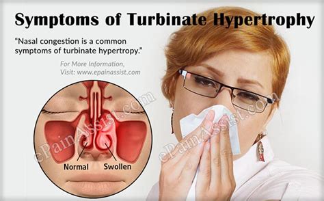 Turbinate Hypertrophycausessymptomsdiagnosis