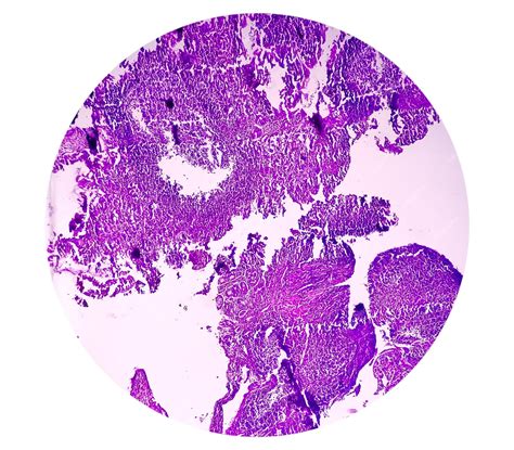 Premium Photo Chronic Ileitis Or Inflammation Of The Ileum Caused By