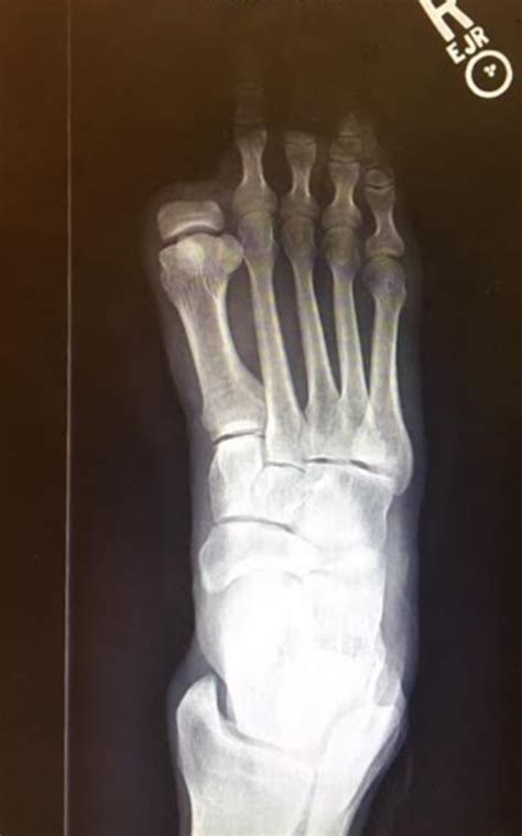 Hallux Amputation Part 1 What Is Next For This Person — The Gait Guys