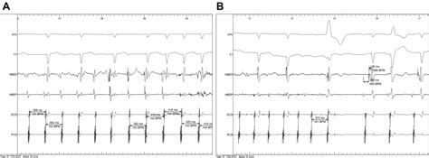 A Rare Case Report Of Variable Degrees Of Atrioventricular Block During Atrioventricular Nodal
