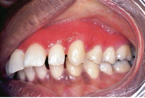 Discoid Lupus Erythmatosus Of Gingiva Medizzy