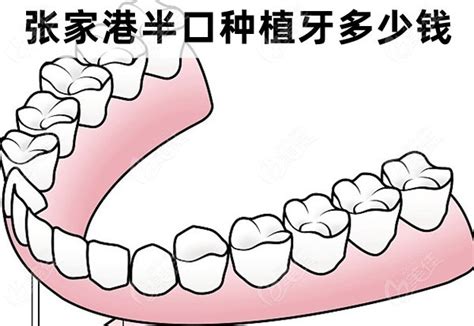 张家港半口种植牙多少钱4颗5颗6颗半口种植牙价格不同 美佳社区