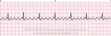 Atrial Flutter Ecg