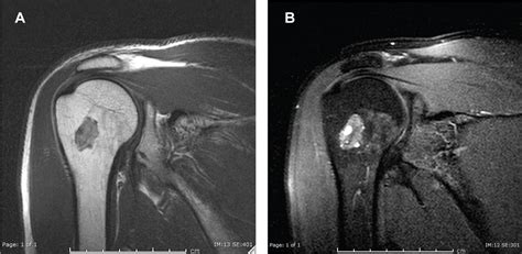 Enchondroma Mri