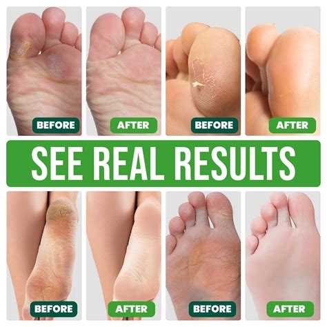 Veracare Lavender Foot Peel Mask 2 Pairs Exfoliating And Moisturizing