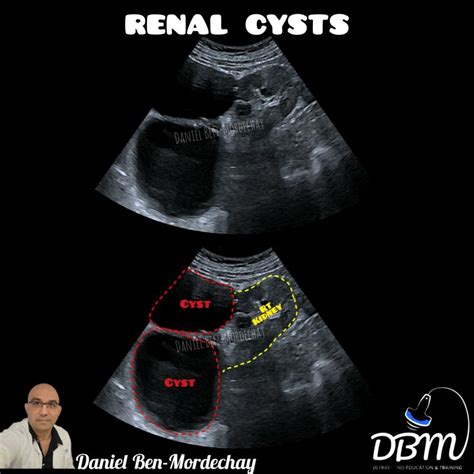 Ultrasound Of Renal Cysts In The Elderly Benign And Asymptomatic