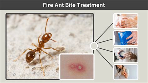 Fire Ant Bites Symptoms Treatment Identification With Pictures
