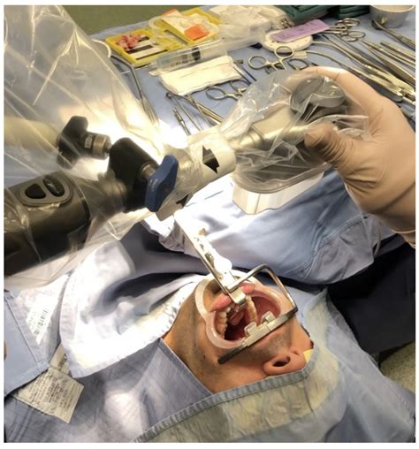 Multi Level 3d Surgery For Obstructive Sleep Apnea Could It Be The Future