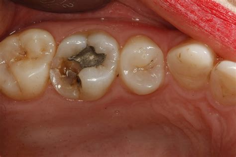 Chipped Tooth Repair Molar