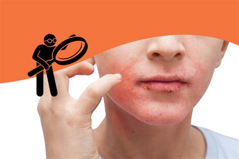 Perioral Dermatitis Treatment Dermo Direct Teledermatology