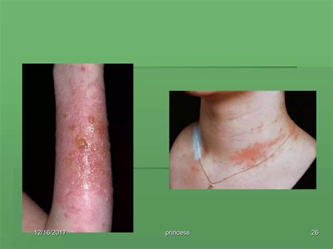 Immunologic Disorders Ppt Pptx