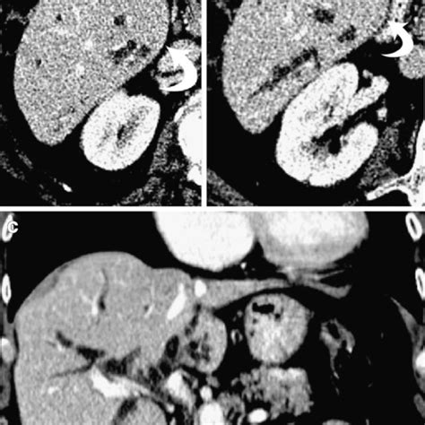 Ac A Patient With Left Lobe Atrophy And Right Lobe Hypertrophy