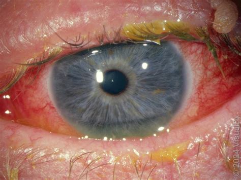 How Long Does Pink Eye Last Pictures And Recovery Tips Goodrx