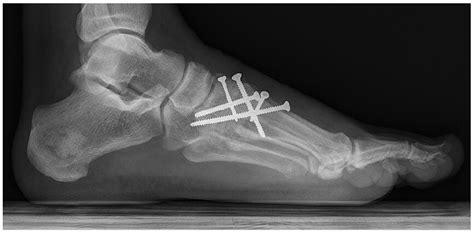 Clinical Outcomes After Orif Vs Arthrodesis For Subtle Lisfranc
