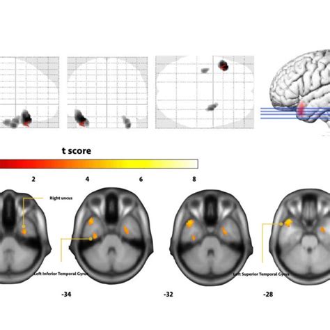 Voxel Based Morphometry Analysis Between Pd Group And Nc Group A Download Scientific Diagram
