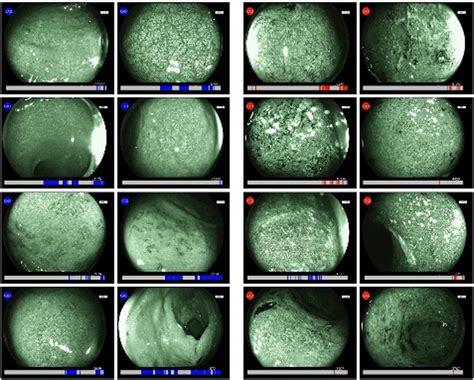Real Time Automated Assessment Of Histological Disease Activity In