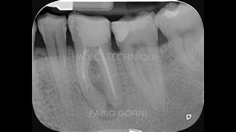 Eighteeth On Linkedin Fastpackpro Fastfill Obturation Eighteeth