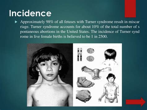 Frequency Of Turners Syndrome At Tammy Dunn Blog