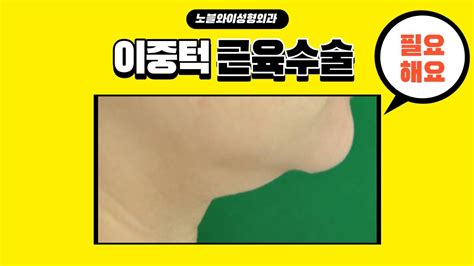 이중턱근육묶기 잘알아보고 해야합니다 이중턱근육수술 알아보기 ★더보기란 필독★ Youtube