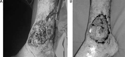 Figure 1 From Pyoderma Gangrenosum Associated With Inflammatory Bowel Disease Report Of Two