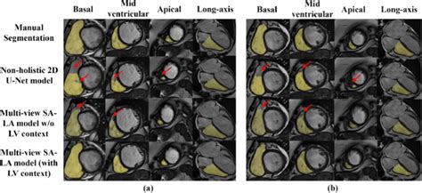 Predicted Segmentation Maps Of The Rv In The A End Diastolic And B