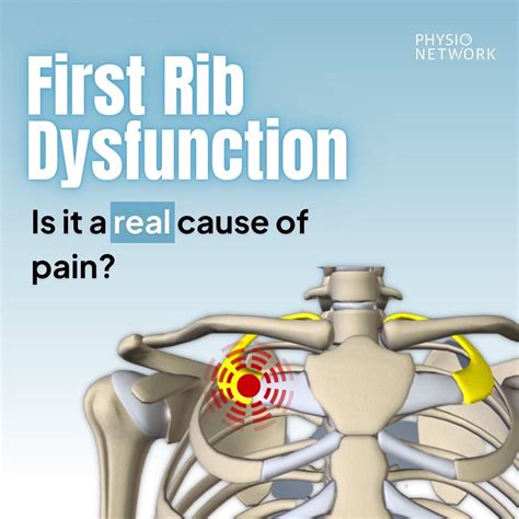 Physio Network On Linkedin 🤨 First Rib Dysfunction ⁠ ⁠ 👆🏻 Ever Heard About It⁠ ⁠ 💡 Want To