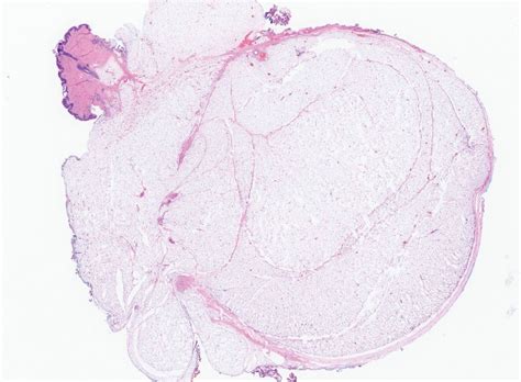 Scalp Nodule With Copious Fluid Mdedge