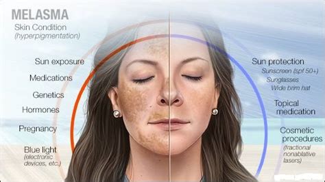 Melasma Laser Treatment Cost And Causes Skinalaya