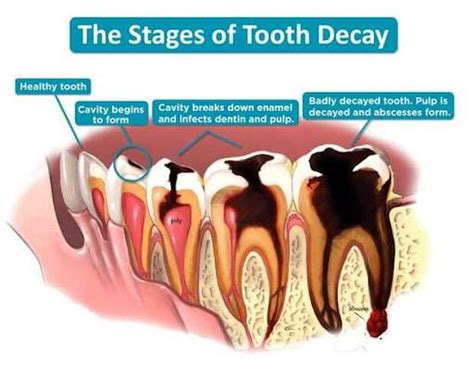 The Hidden Dangers Of Untreated Tooth Decay