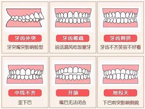 正确的牙齿咬合图是什么样的 深圳爱康健口腔医院 官网