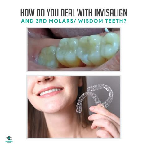 How To Use Invisalign For Cases With Wisdom Teeth