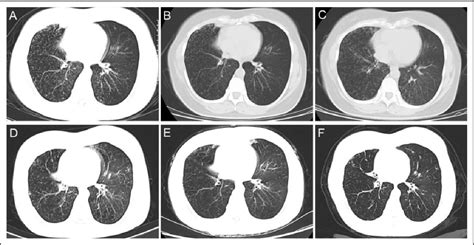 Figure 1 From Diffuse Panbronchiolitis A Case Report From A Chinese